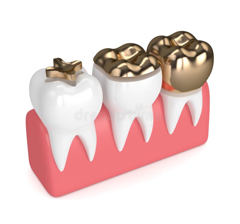 3d Render of Teeth with Different Types of Dental Gold Filling Stock ...