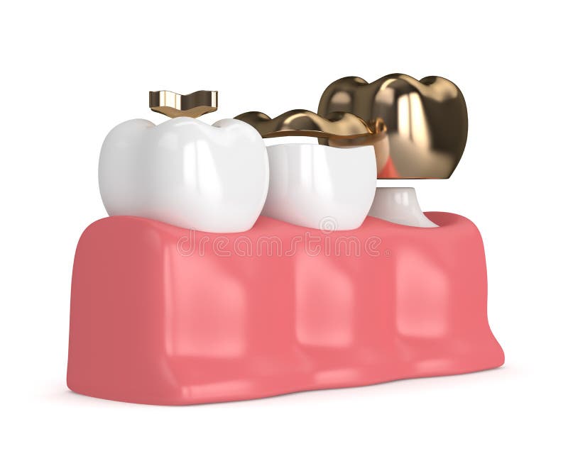 3d Render of Teeth with Different Types of Dental Gold Filling Stock ...