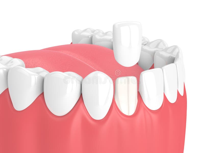 3d Render of Teeth with Orthodontic Braces and Dental Implants Stock ...