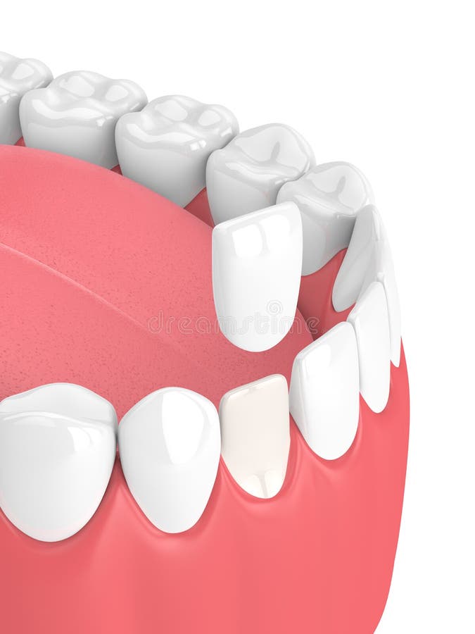3d Render of Teeth with Veneer Stock Illustration - Illustration of ...