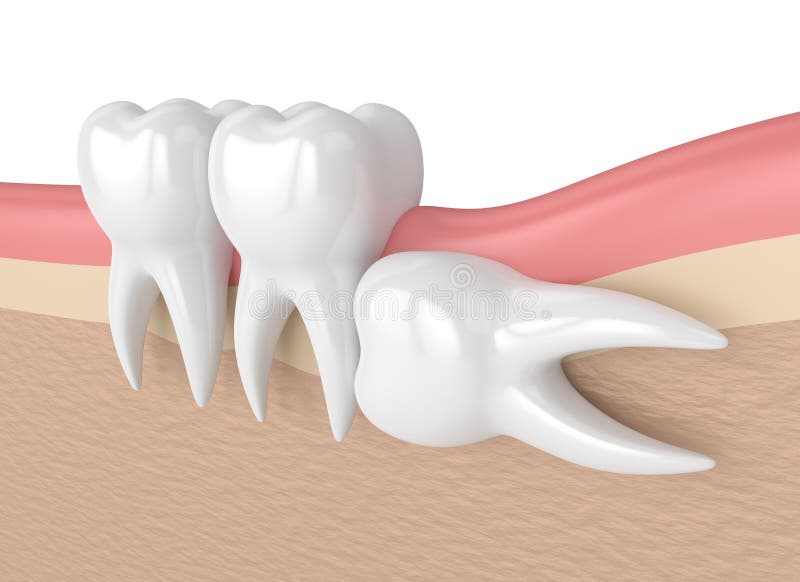 3d Render of Teeth with Wisdom Horizontal Impaction Stock Illustration ...