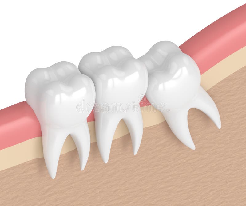 3d Render of Teeth with Wisdom Mesial Impaction Stock Illustration ...