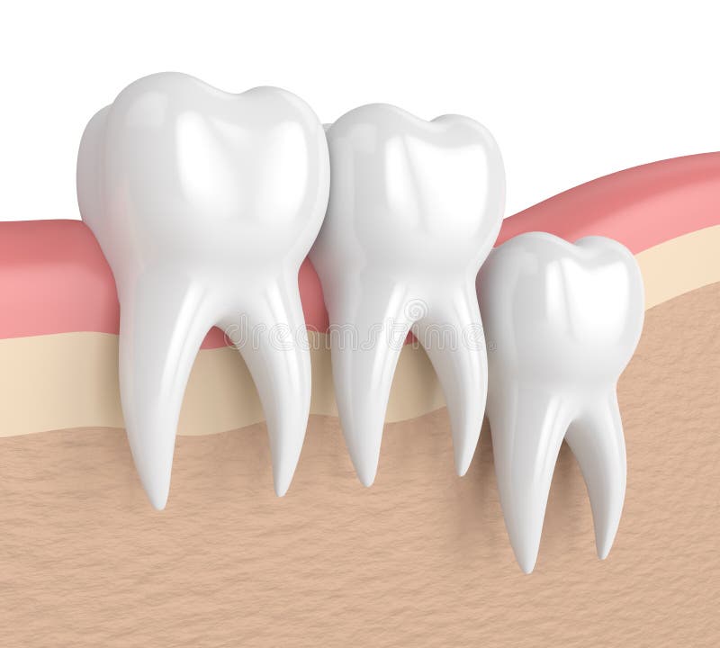 3d Render of Teeth with Wisdom Vertical Impaction Stock Illustration ...
