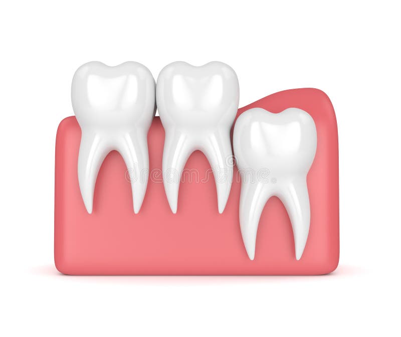 3d Render of Teeth with Wisdom Vertical Impaction Stock Illustration ...