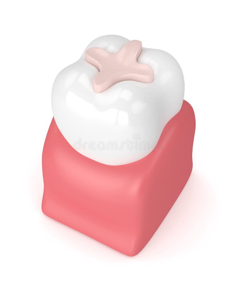 3d Render of Tooth with Dental Inlay Filling Stock Illustration ...