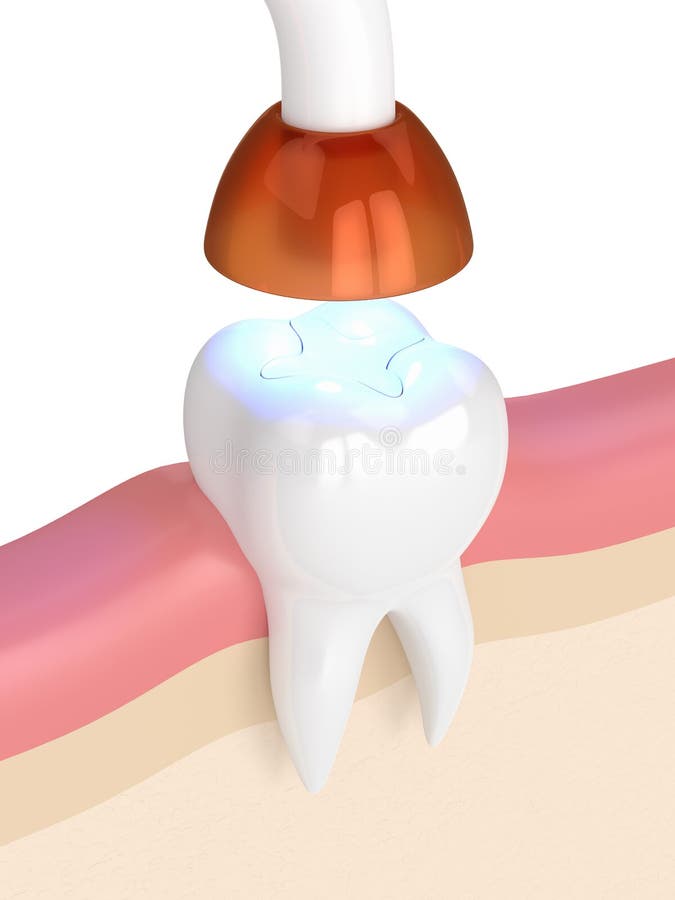 3d Render of Tooth with Dental Polymerization Lamp and Light Cured ...