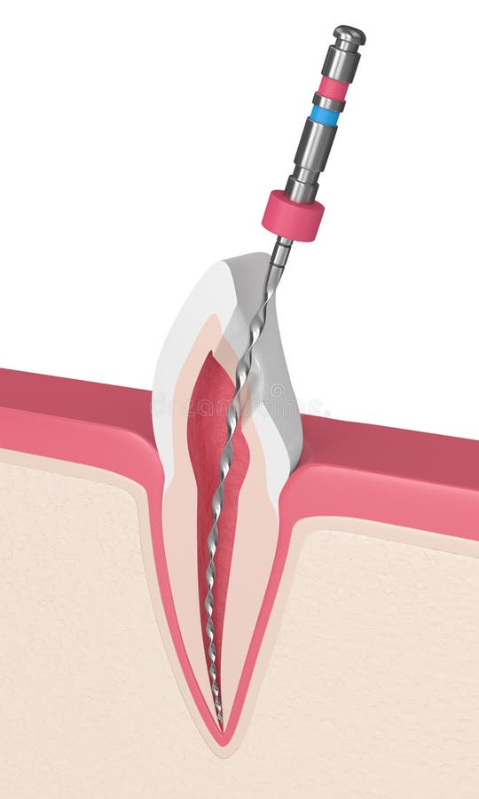 Endodontic File Stock Illustrations – 82 Endodontic File Stock ...