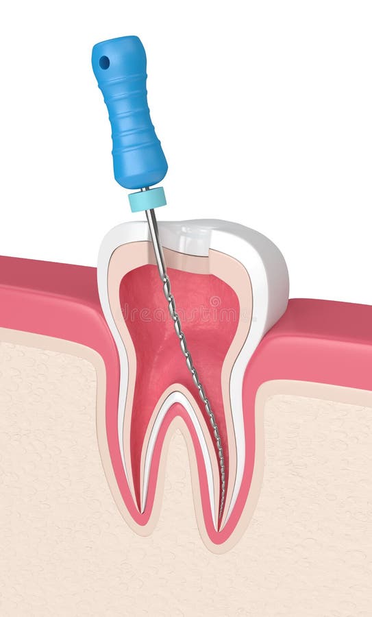 3d Render of Tooth with Endodontic File in Gums Stock Illustration ...