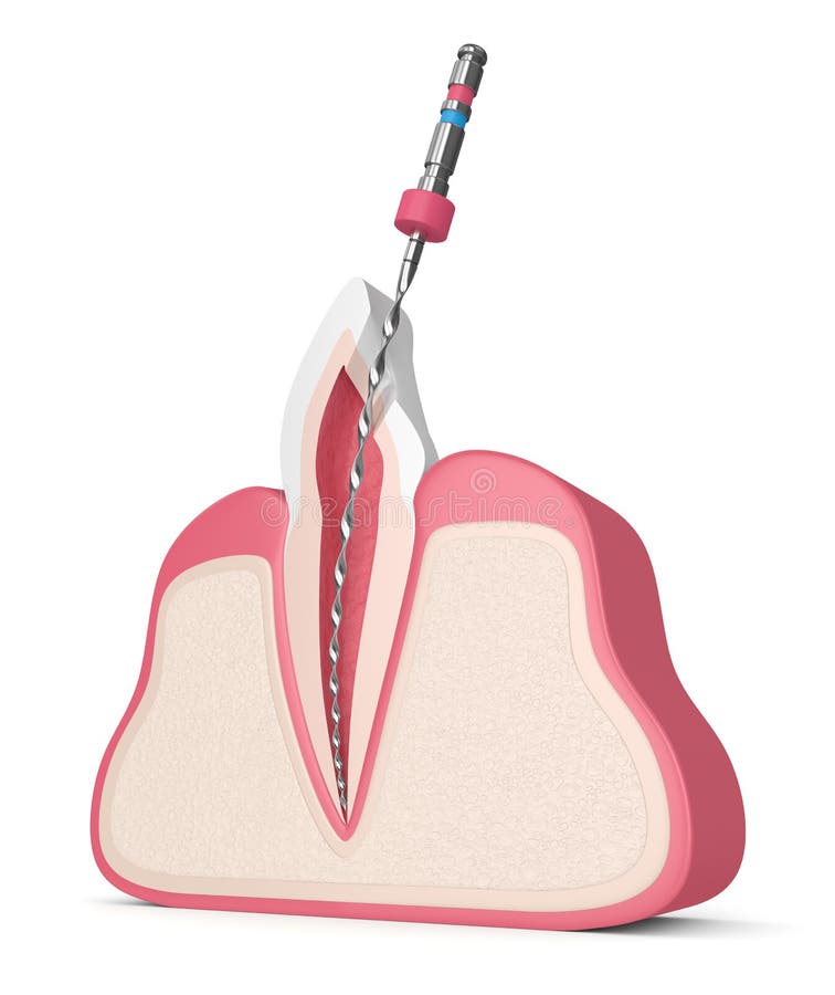 Endodontic File Stock Illustrations – 82 Endodontic File Stock ...