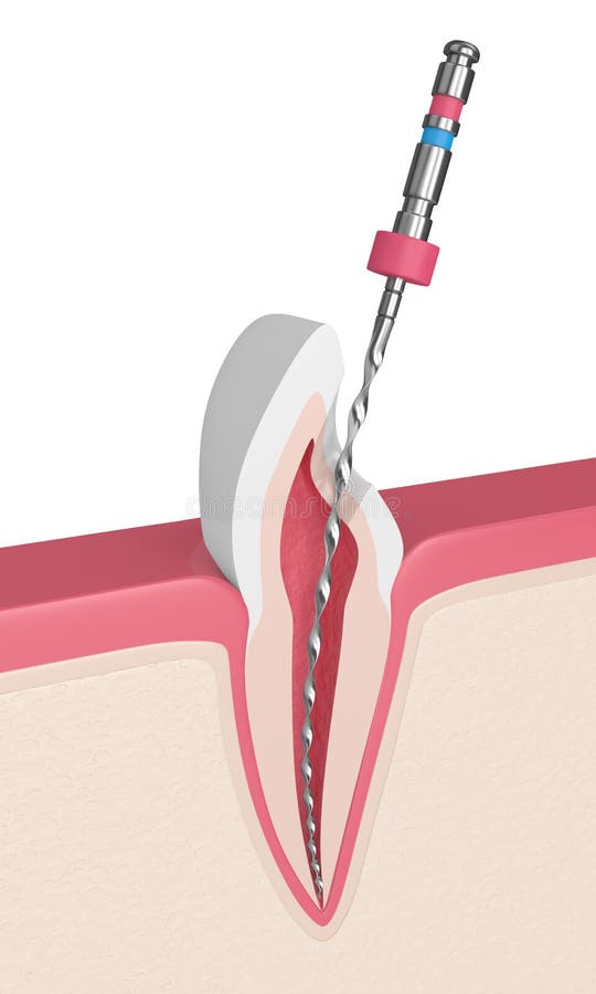 Tooth with Endodontic File. Root Canal Treatment Concept. Endodontics ...