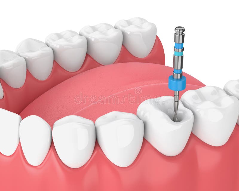 Endodontic File Stock Illustrations – 84 Endodontic File Stock ...