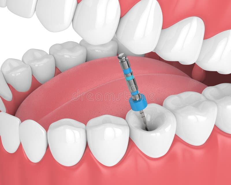 3d Render of Tooth with Endodontic File in Jaw Stock Illustration ...