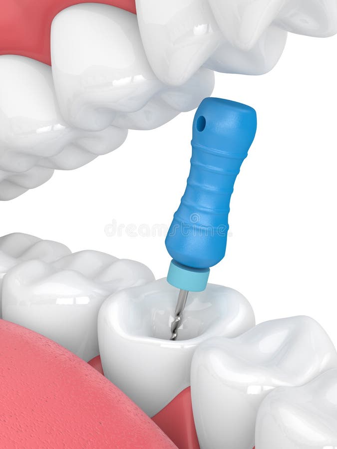 3d Render of Tooth with Endodontic File in Jaw Stock Illustration ...