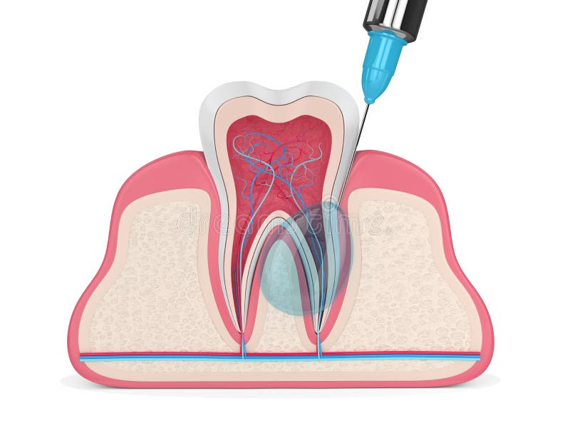 3d Render of Tooth in Gums with Intraligamentary Anesthesia Procedure ...