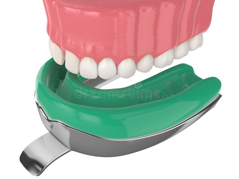 3d Render of Upper Jaw with Dental Impression Tray Stock Illustration ...