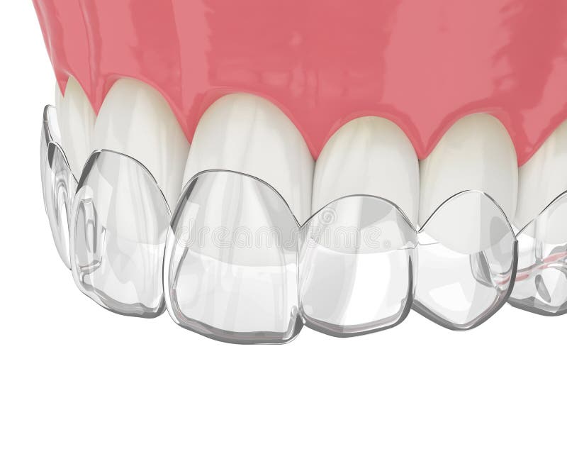 3d Render of Upper Jaw with Invisalign Removable Retainer Stock ...