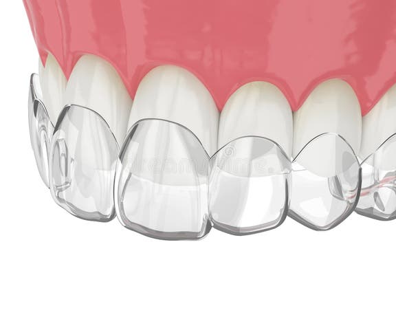 Invisalign Stock Illustrations – 519 Invisalign Stock Illustrations ...