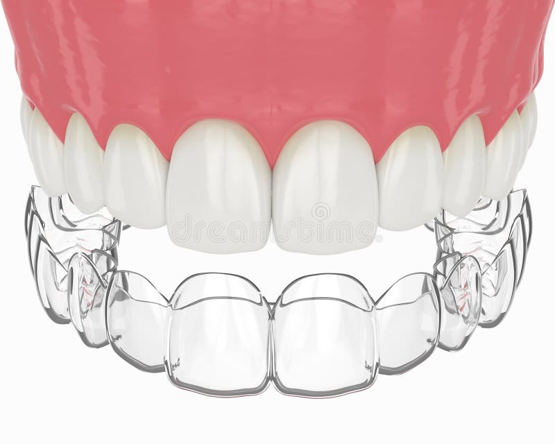 3d Render of Upper Jaw with Invisalign Removable Retainer Stock ...