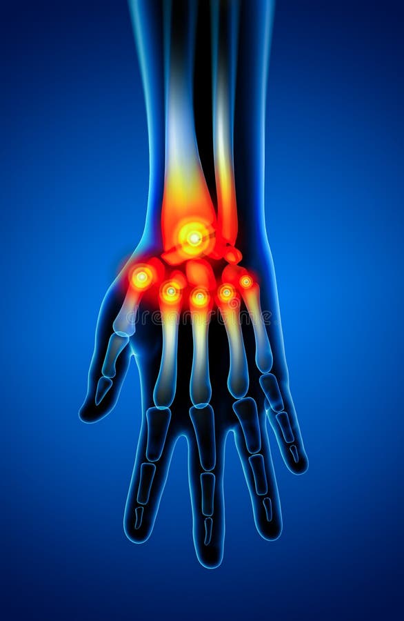Hand pain stock illustration. Illustration of rheumatism - 35065430
