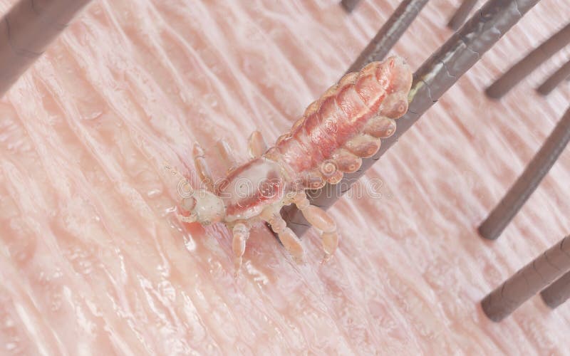 Lice Problem Stock Illustrations – 129 Lice Problem Stock Illustrations ...