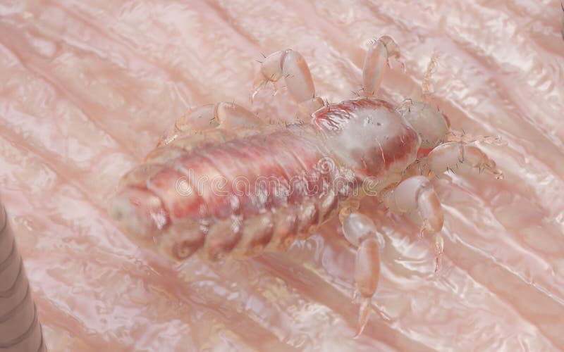 A head louse stock illustration. Illustration of head - 165074473