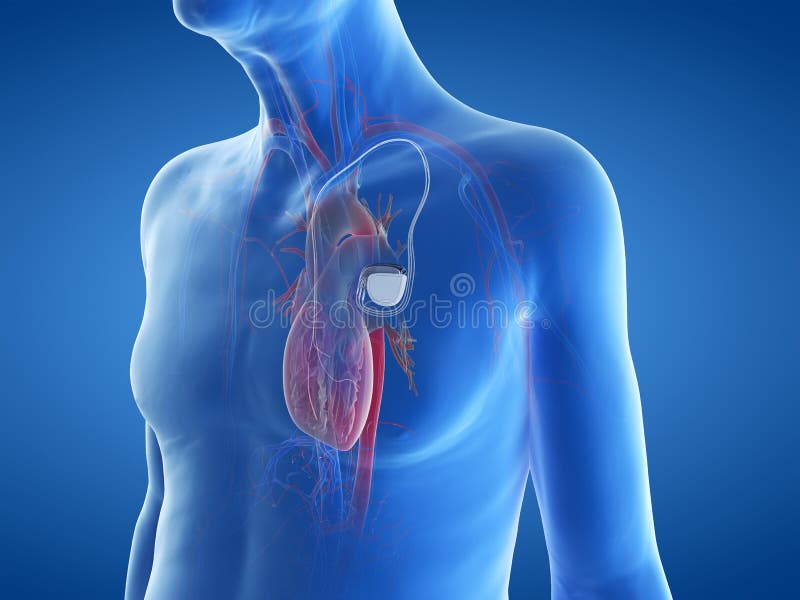 Pacemaker Body Stock Illustrations – 161 Pacemaker Body Stock ...