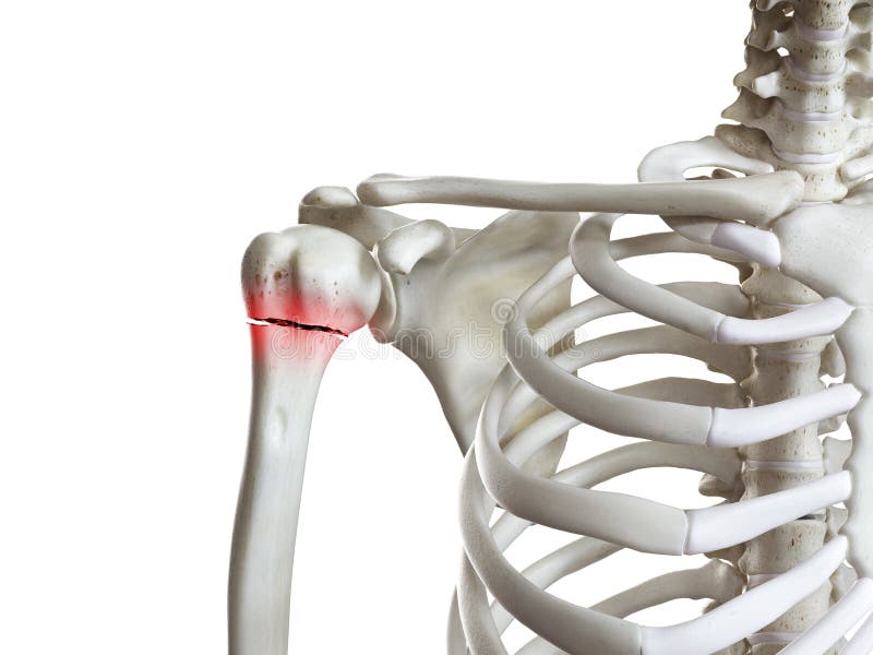 A broken humerus stock illustration. Illustration of anatomy - 157583382
