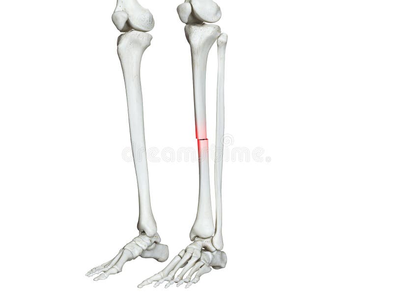 A broken tibia stock illustration. Illustration of bones - 157583634