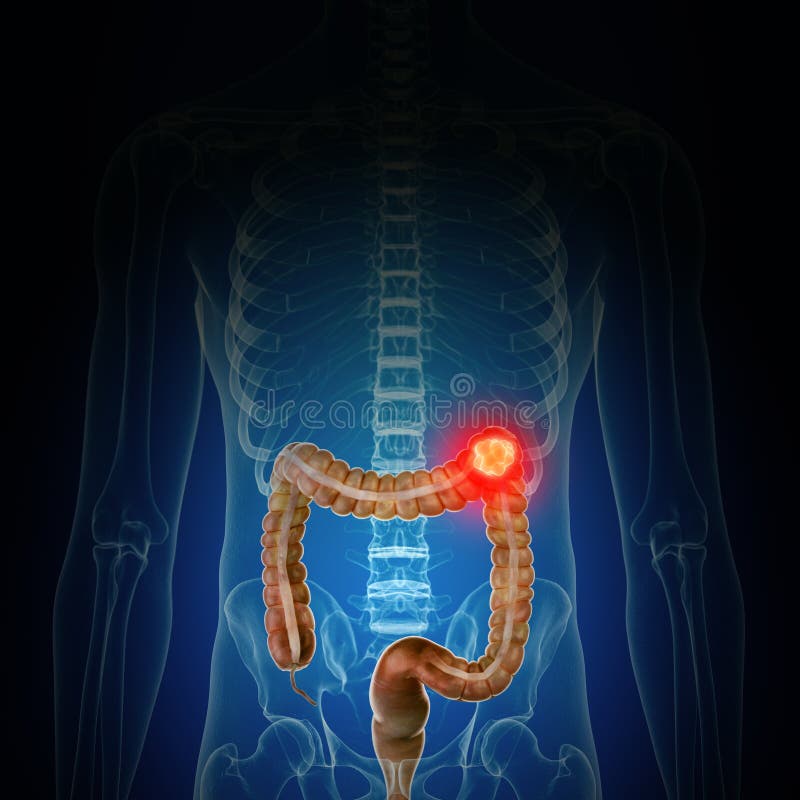 Colon Cancer Stock Illustration Illustration Of Colon 11733971