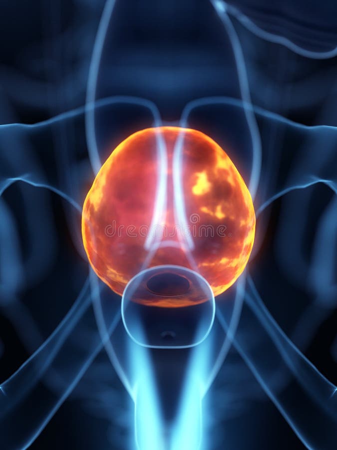 A diseased bladder stock illustration. Illustration of disease - 142497182