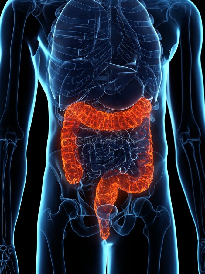 A diseased colon stock illustration. Illustration of inflammatory ...