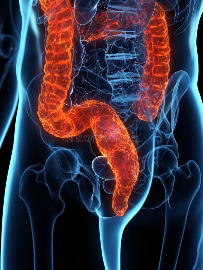 A diseased colon stock illustration. Illustration of inflamed - 142497914