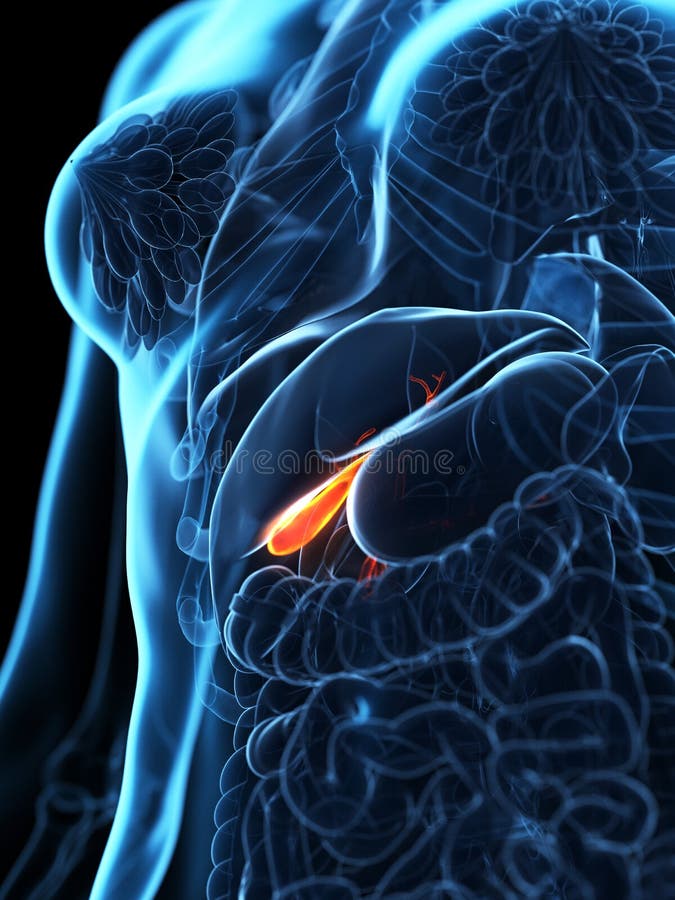 A diseased gallbladder stock illustration. Illustration of inside ...