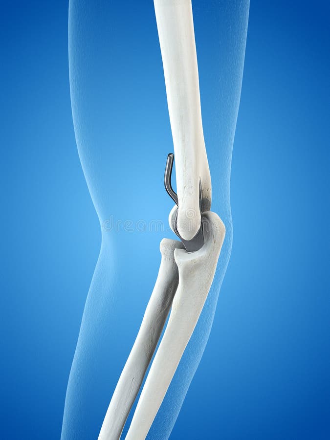 An elbow replacement stock illustration. Illustration of artwork ...
