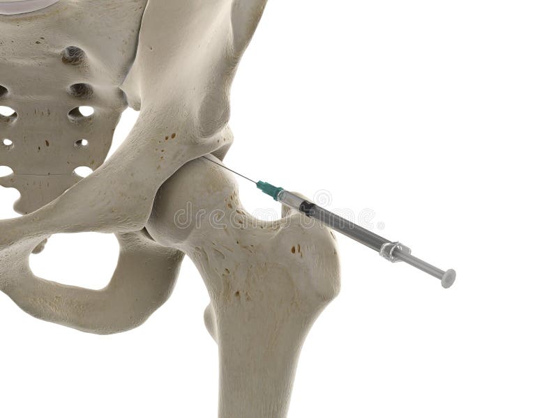 A hip joint injection stock illustration. Illustration of graphic ...