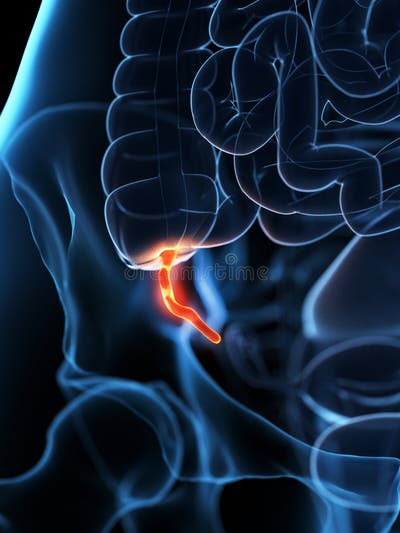 An inflamed appendix stock illustration. Illustration of anatomy ...