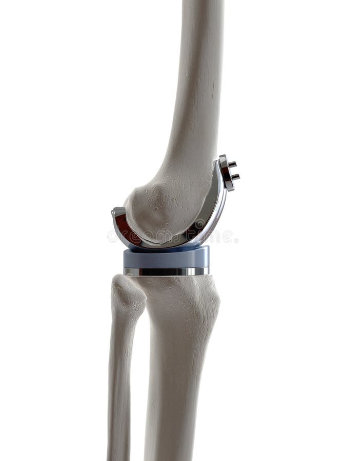 Metal knee stock illustration. Illustration of metallic - 30722111