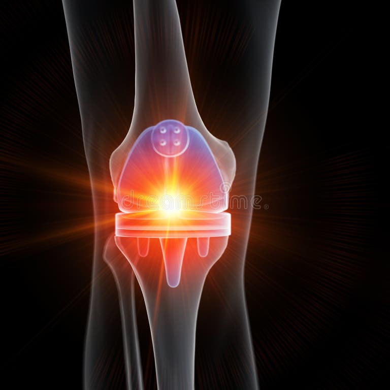 Knee Replacement Stock Illustrations – 907 Knee Replacement Stock ...