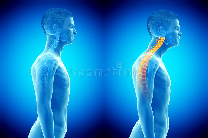 A forward head posture stock illustration. Illustration of infection ...