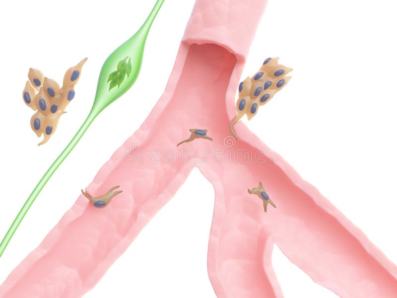 Metastasis stock vector. Illustration of carcinoma, gene - 24573929