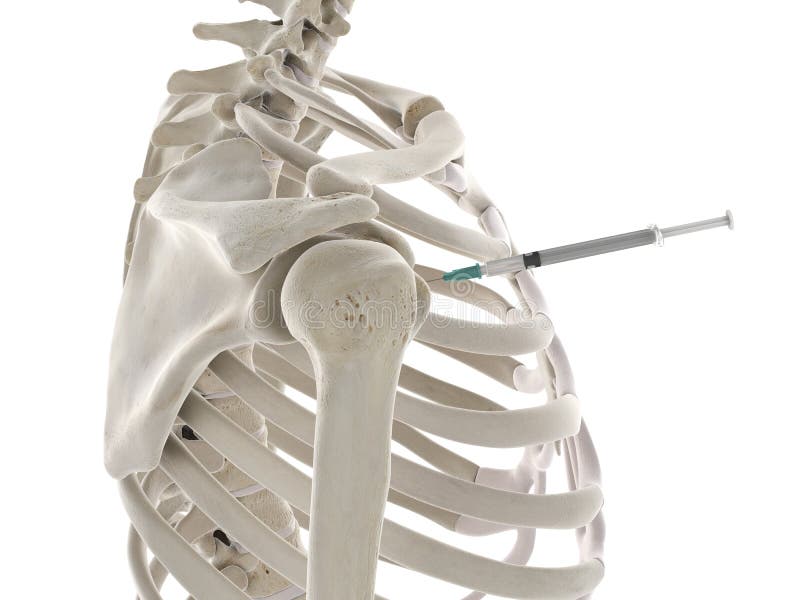 A shoulder injection stock illustration. Illustration of accurate ...
