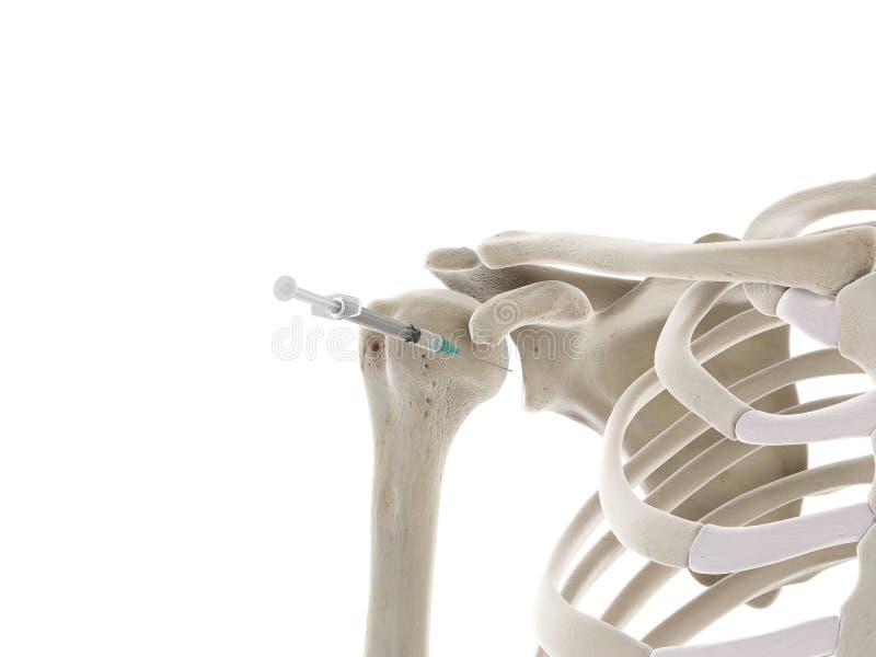 A shoulder injection stock illustration. Illustration of injection ...