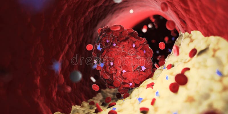 A thrombus stock illustration. Illustration of life - 169378908