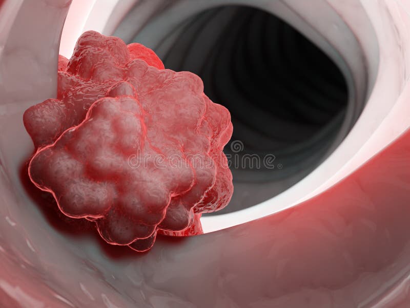 A tumor in the colon stock photo. Image of canal, graphic - 162283792