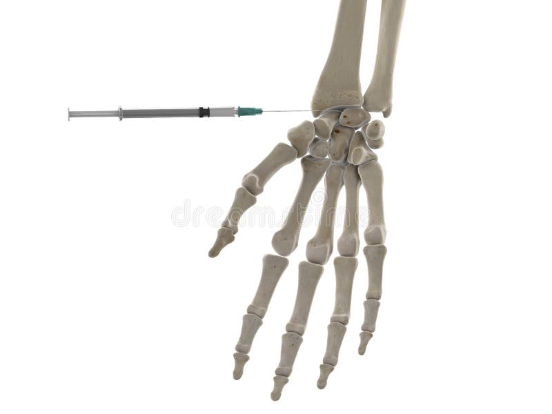 A wrist injection stock illustration. Illustration of biology - 169374076