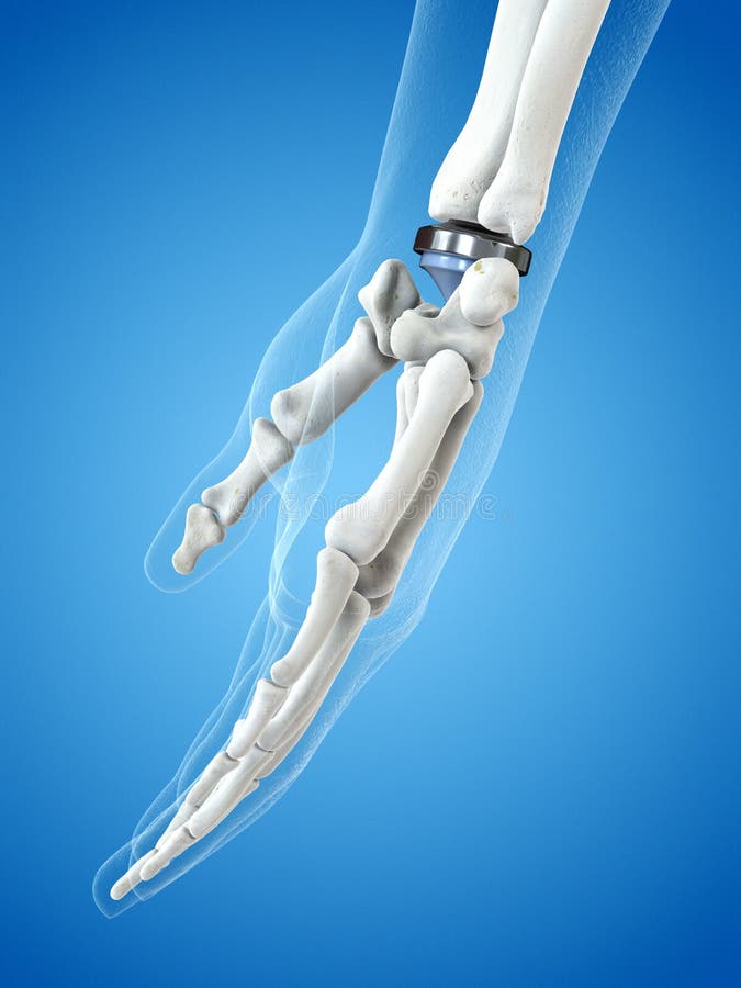 A wrist replacement stock illustration. Illustration of surgical ...