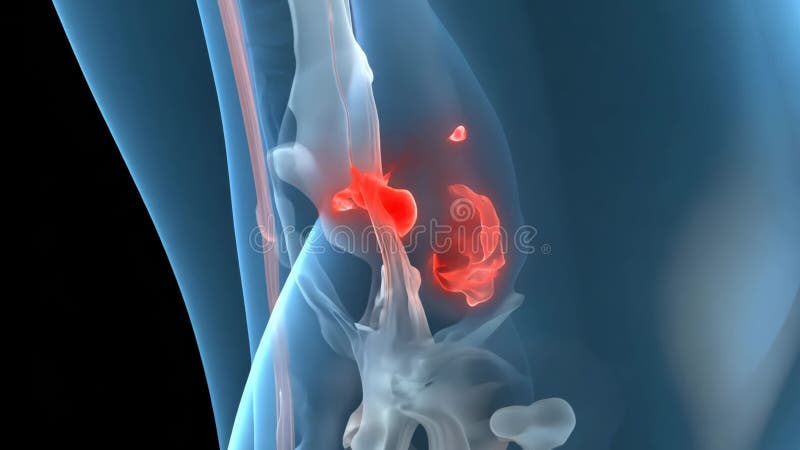 3D Rendered Visualization of Human Hip Anatomy Showing Inflammation and ...
