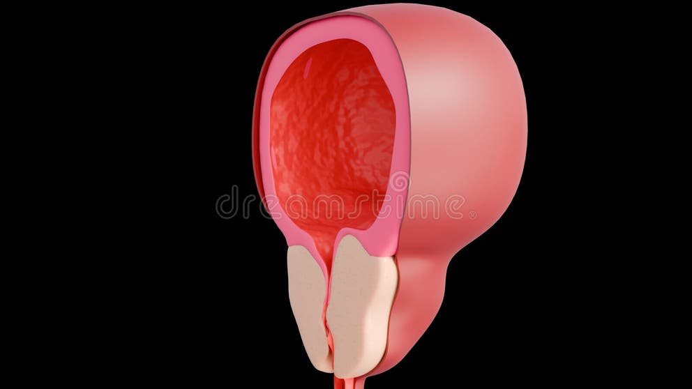 3d Rendering of Benign Prostatic Hyperplasia (BPH) Stock Illustration ...