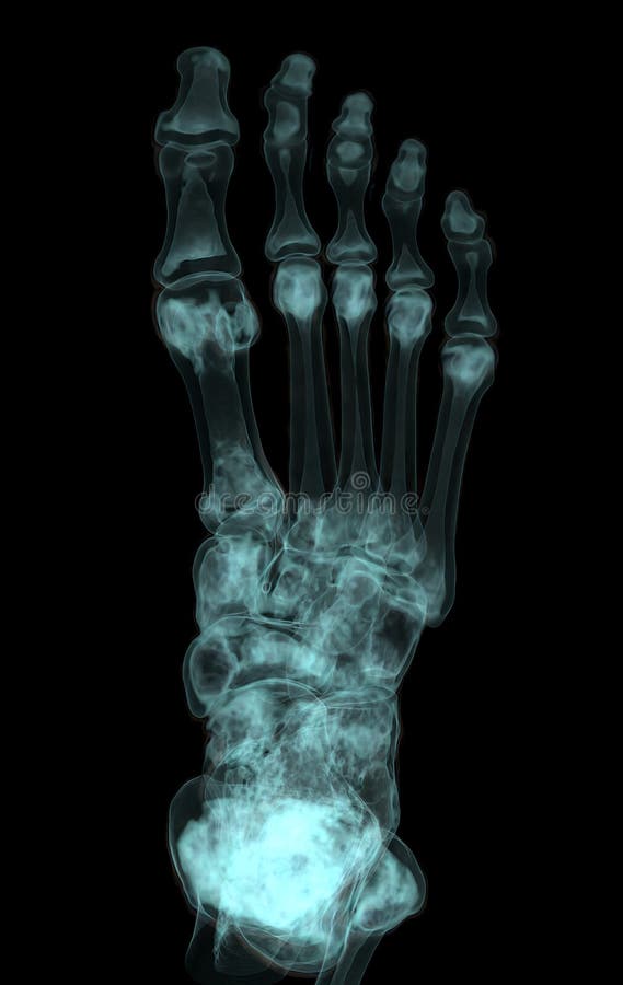 3D Rendering of the Foot Bones for Diagnosis Bone Fracture and ...