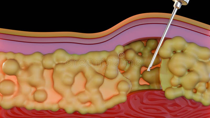 A Cannula is Removing Fat from the Subcutaneous Layer. Stock ...